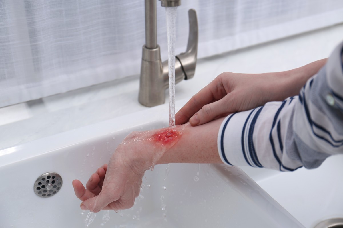 What to Do After Sustaining a Burn Injury at Work? - Wagner Workers ...